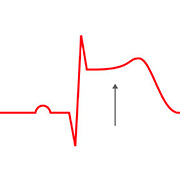 Infarctus aigu du myocarde - L’électrocardiogramme pour confirmer le ...