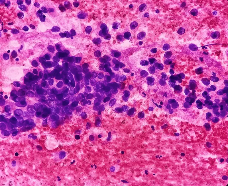 Melanoom - Huidkankervaccins al in 2025 verkrijgbaar? | Medipedia