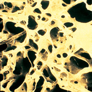 Osteoporose - Opbouw en afbraak van de botten | Medipedia