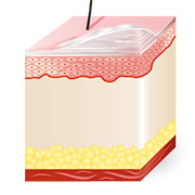 Psoriasis - Qu’est-ce que le psoriasis? | Medipedia