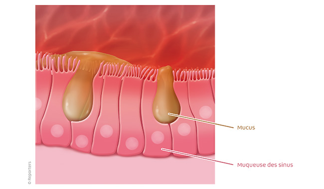 Sinusitis - Onderzoeken | Medipedia