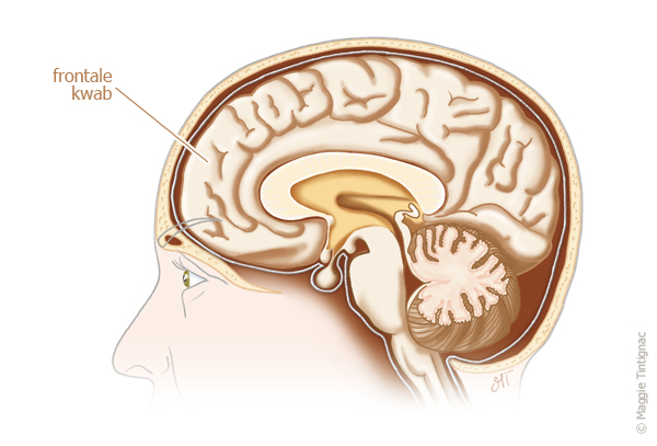ADHD - Oorzaken | Medipedia