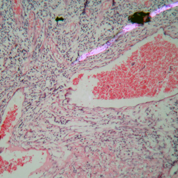 Tumeur neuro-endocrine - Le rôle spécifique des cellules neuro ...